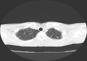 Tuberculosis Laríngea. Presentación de un caso | Pérez Paz | MediCiego