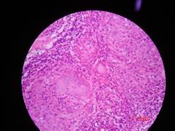 Tuberculosis Laríngea. Presentación de un caso | Pérez Paz | Mediciego