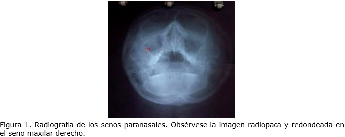 Mucocele de seno maxilar | Rodríguez Rodríguez | Mediciego